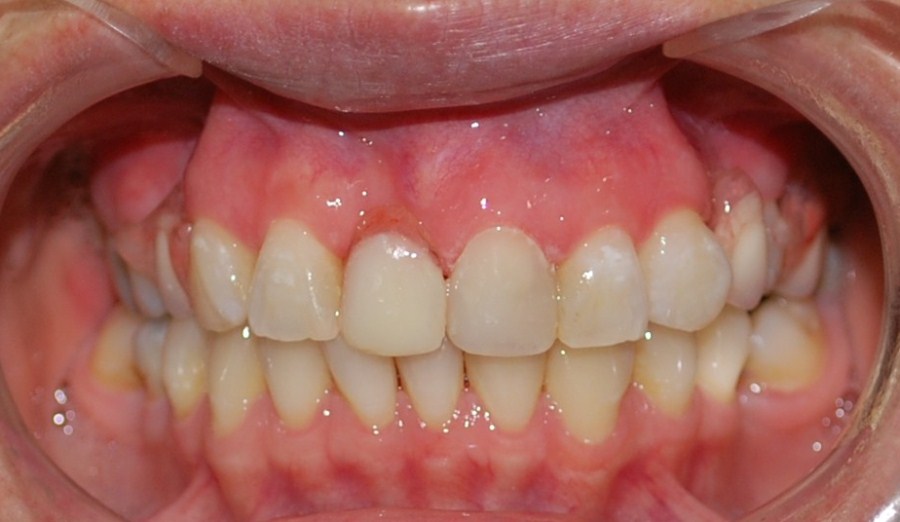 Protesis Flexibles (Deflex)